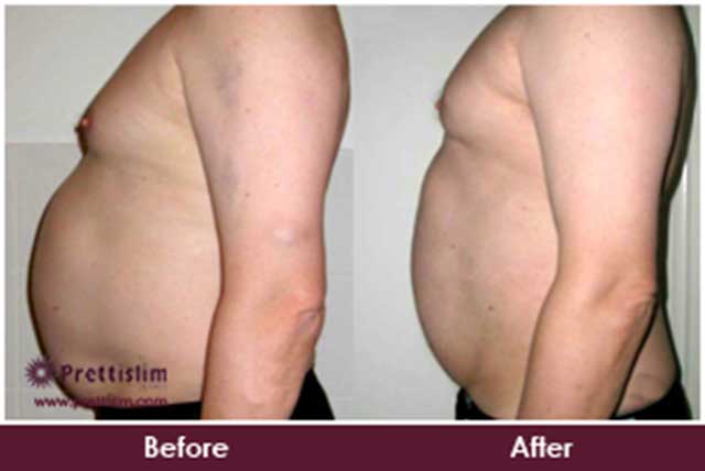 Tummy Tuck Prettislim Clinic