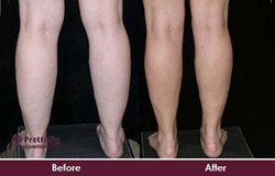 U-lipo Calf Tuck Treatment - Prettislim Clinic